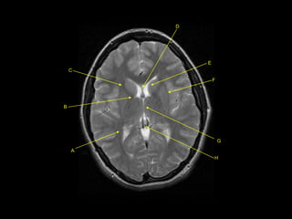 MRI BRAIN AXIAL IMAGE WITH LABELING | PPT | Free Download