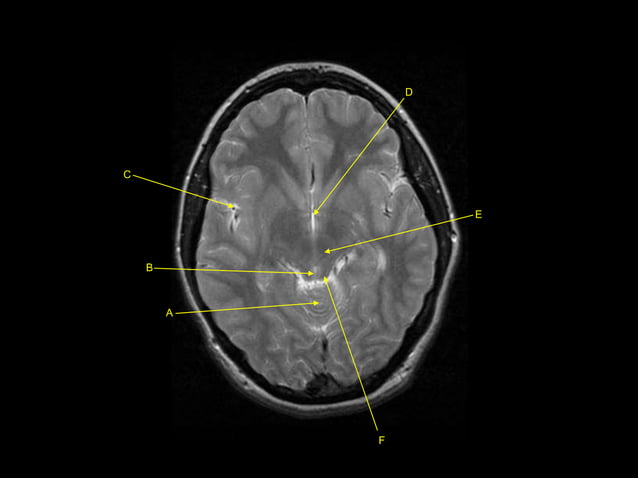 MRI BRAIN AXIAL IMAGE WITH LABELING | PPT