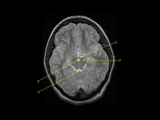 MRI BRAIN AXIAL IMAGE WITH LABELING | PPT