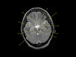 MRI BRAIN AXIAL IMAGE WITH LABELING | PPT