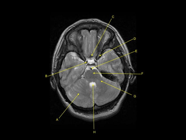 MRI BRAIN AXIAL IMAGE WITH LABELING | PPT