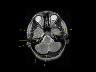 MRI BRAIN AXIAL IMAGE WITH LABELING | PPT