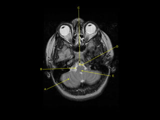 MRI BRAIN AXIAL IMAGE WITH LABELING | PPT