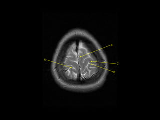 MRI BRAIN AXIAL IMAGE WITH LABELING | PPT