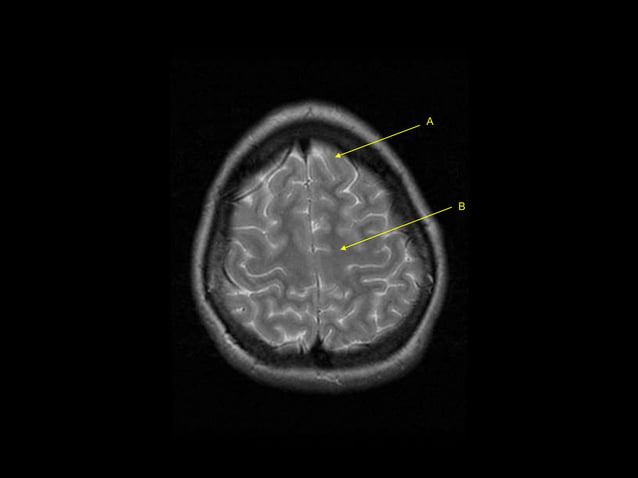 MRI BRAIN AXIAL IMAGE WITH LABELING | PPT