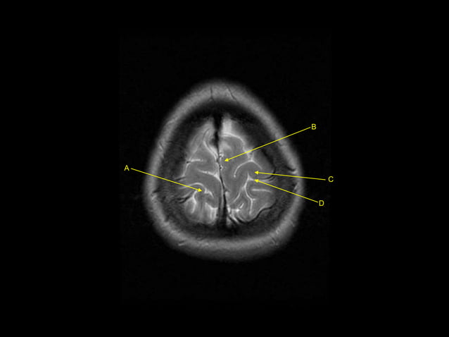 MRI BRAIN AXIAL IMAGE WITH LABELING