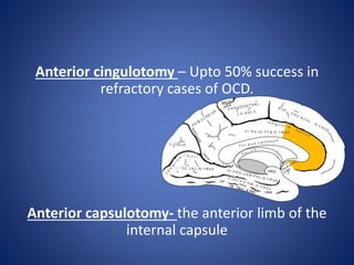 Cingulate Cortex Ocd