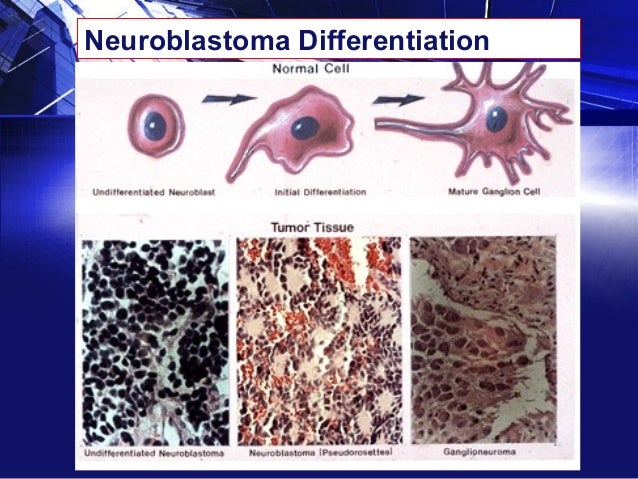 Neuroblastoma 140306132044-phpapp02