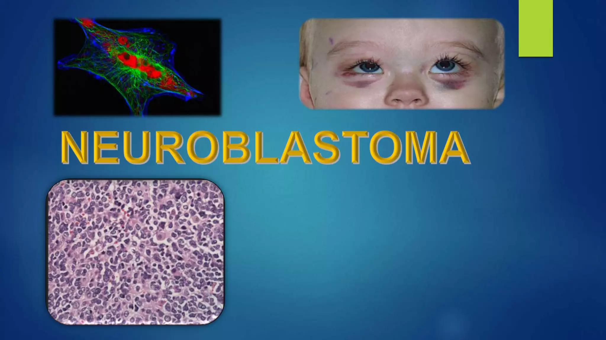 Neuroblastoma | PPTX
