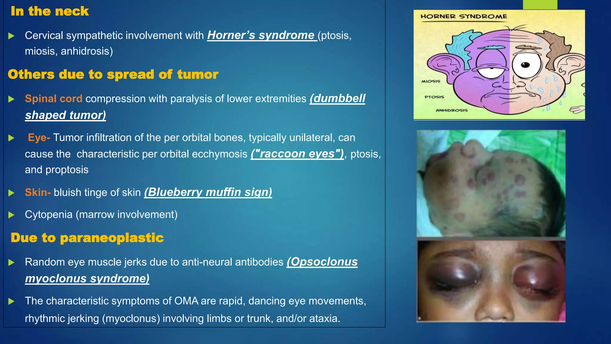 Neuroblastoma | PPTX