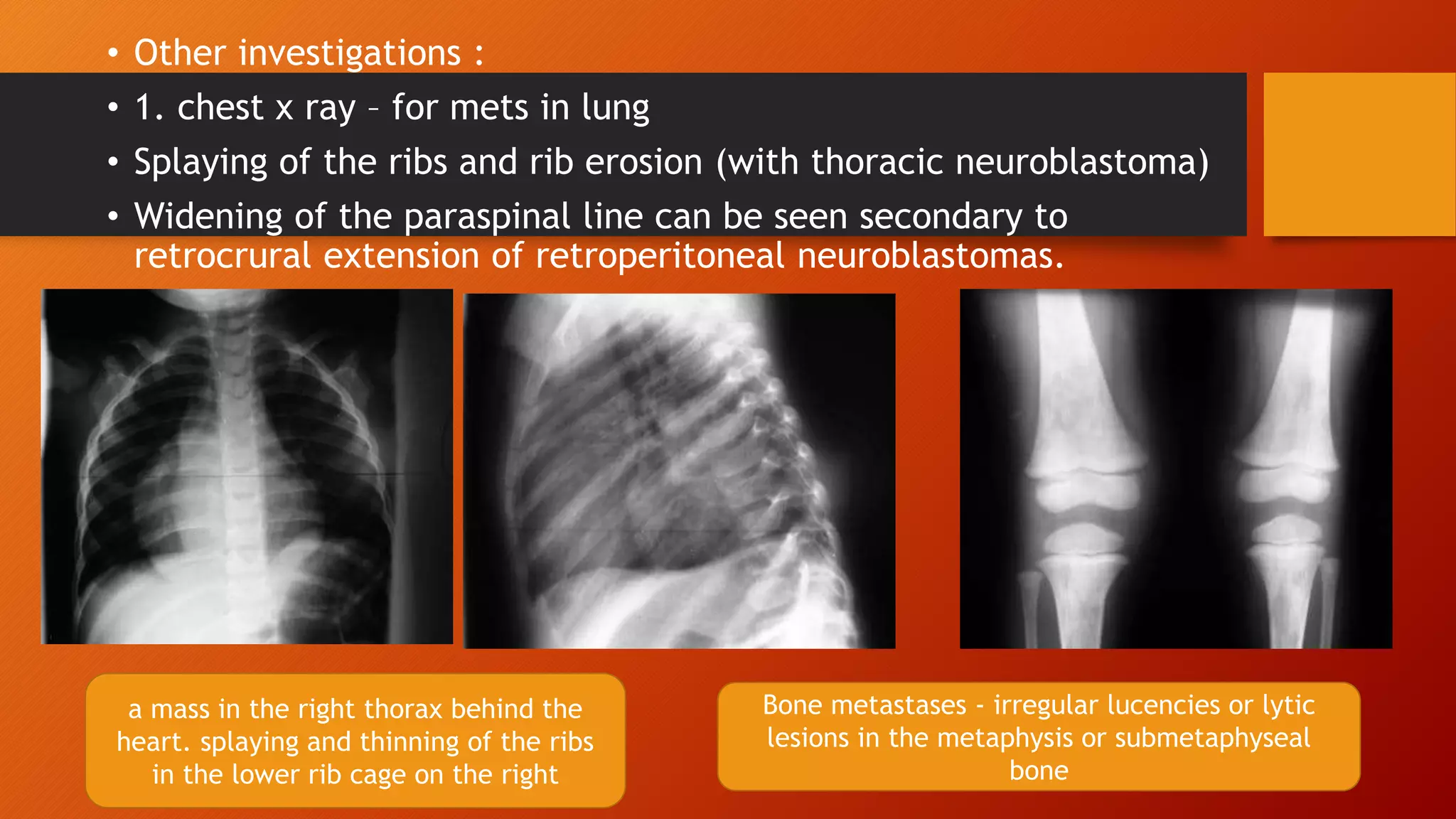 Neuroblastoma imaging | PPTX