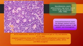 Neuroblastoma imaging | PPTX