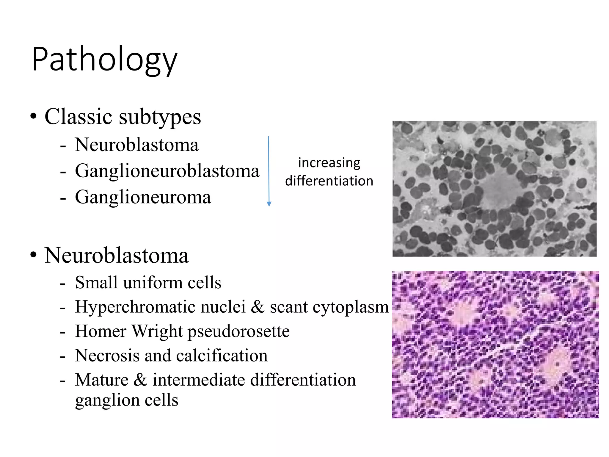 Neuroblastoma | PDF