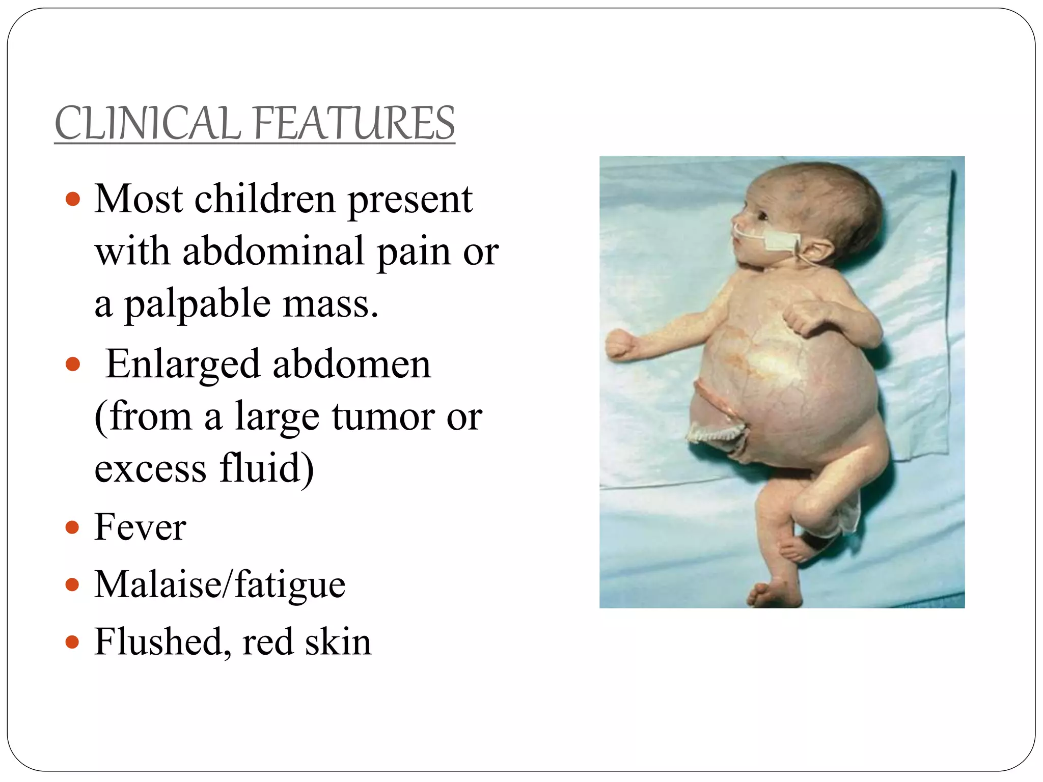 Neuroblastoma | PPTX