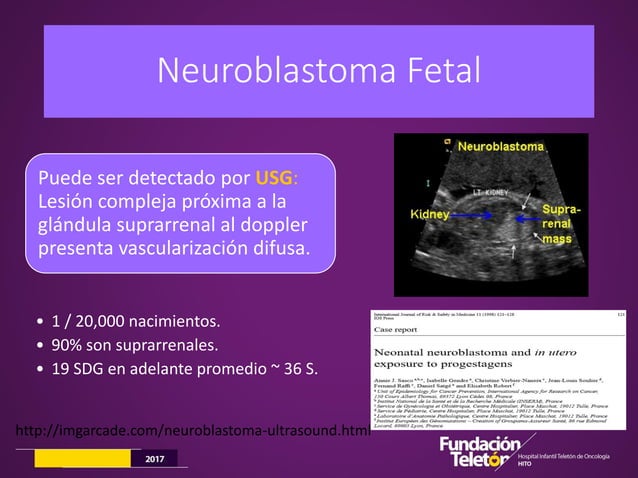 Neuroblastoma Dr. Alfredo Zavala Pardo | PPT