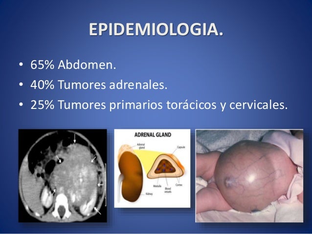 Neuroblastoma en el paciente pediatrico