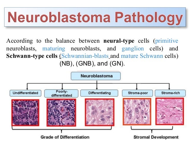 Neuroblastoma presentation