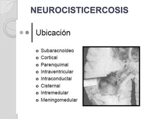 NEUROCYSTICERCOSIS | PDF