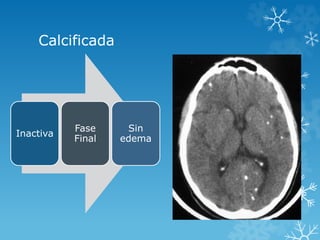 Neurocisticercosis | PPTX