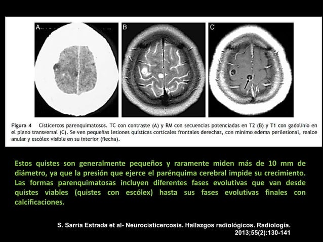 Neurocisticercosis | PPTX
