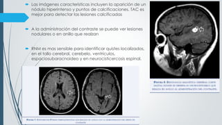 Neurocisticercosis | PPTX