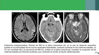 Neurocisticercosis | PDF