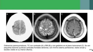 Neurocisticercosis | PDF