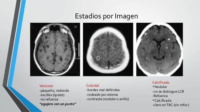 Neurocisticercosis
