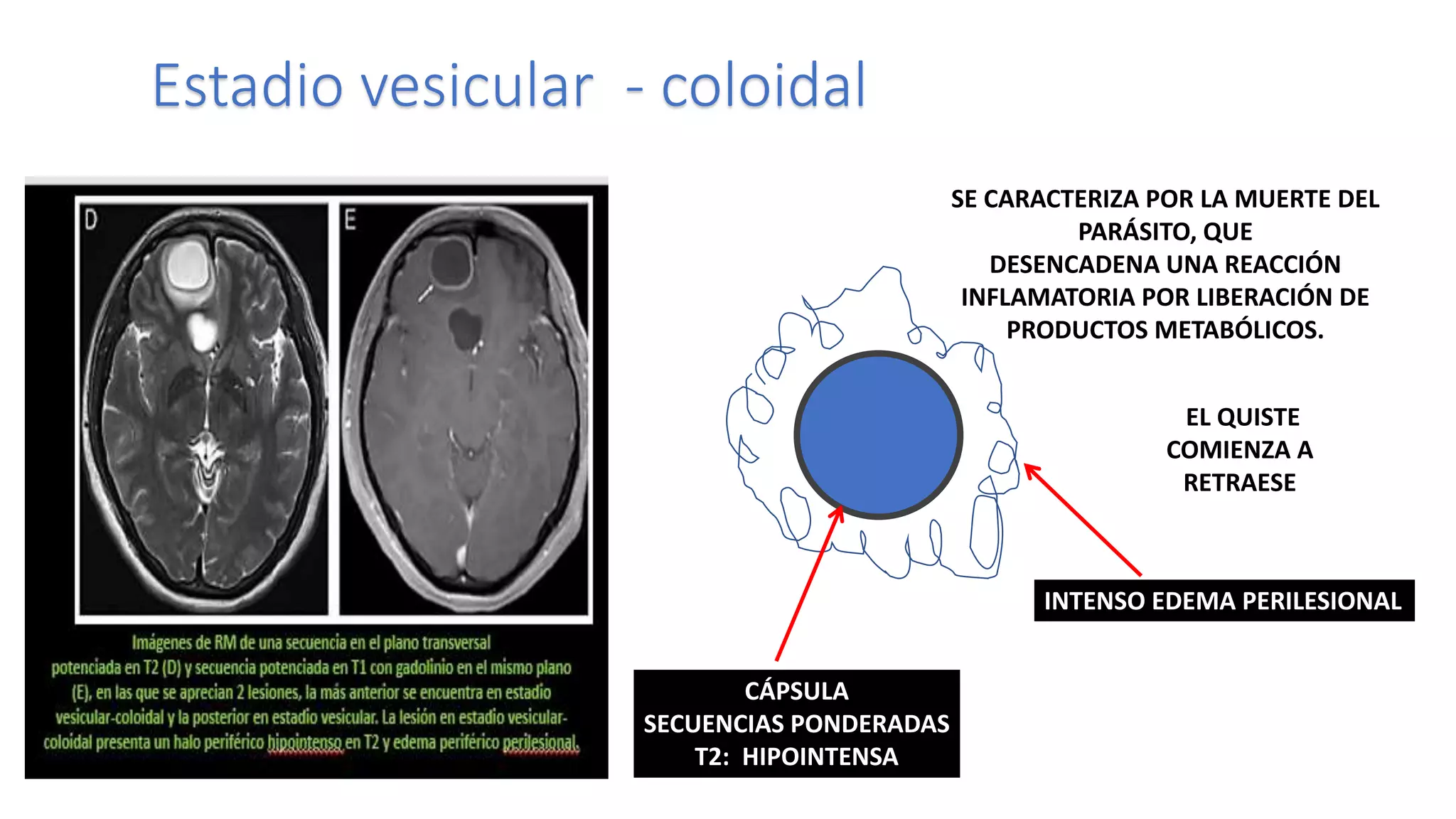 Neurocisticercosis | PPT