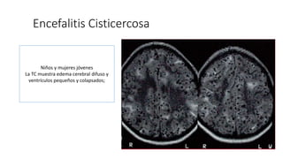 Neurocisticercosis | PPTX