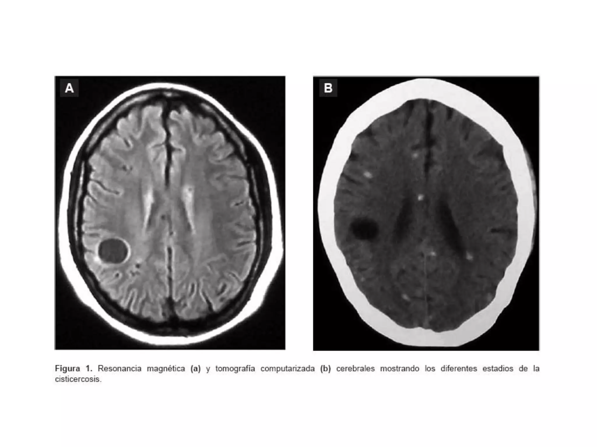 NEUROCISTICERCOSIS.pdf