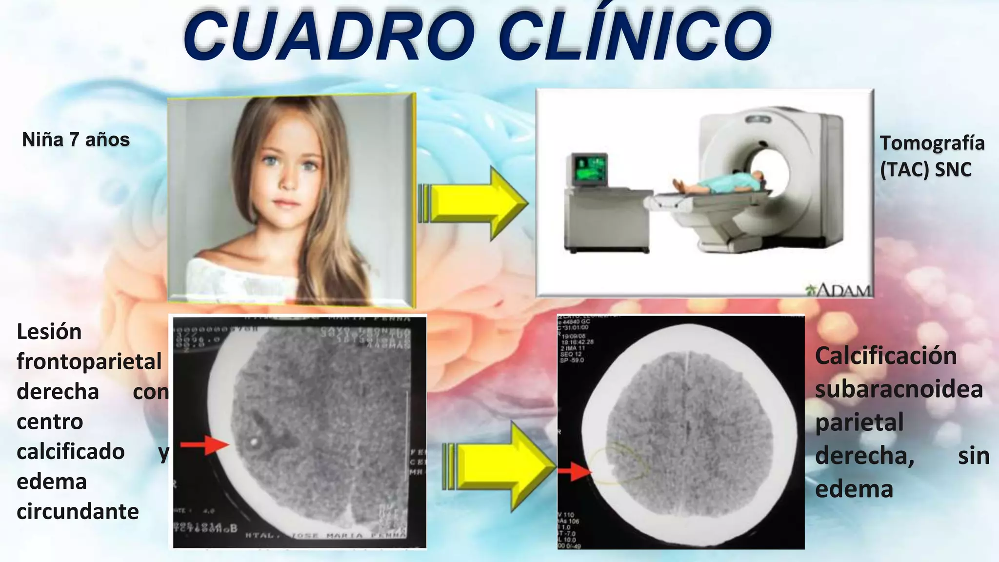 NEUROCISTICERCOSIS.pptx