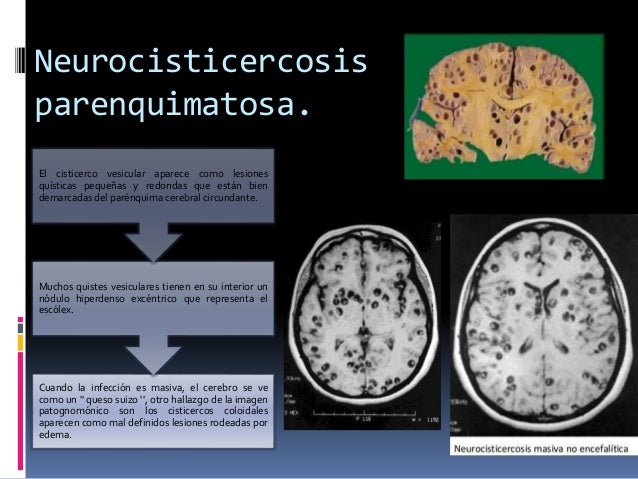 Neurocisticercosis