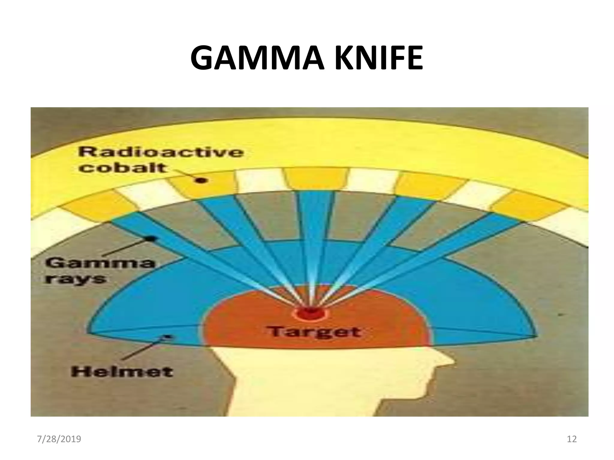 OVERVIEW OF SRS/SRT IN BRAIN TUMORS | PPTX