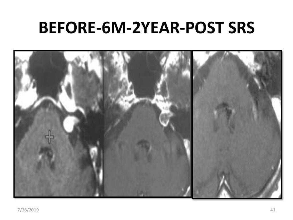 OVERVIEW OF SRS/SRT IN BRAIN TUMORS