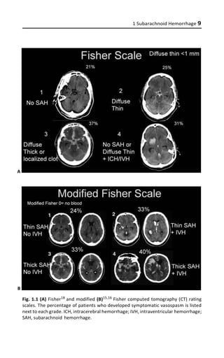 Xuất huyết dưới nhện | PDF