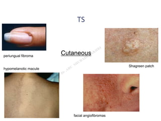 Neurocutaneous disorders | PPT