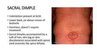 Sacral Dimple With Tuft Of Hair