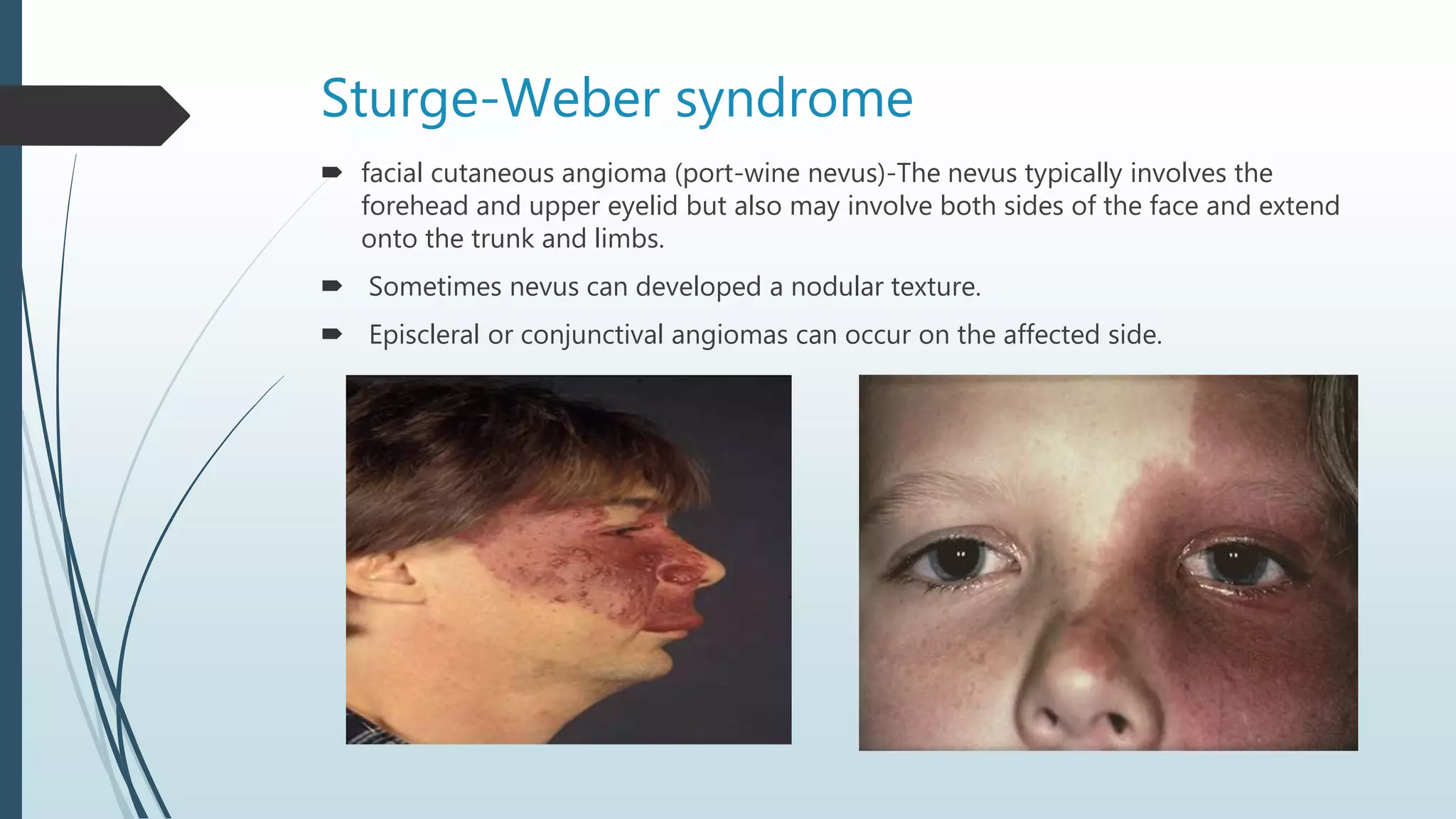 Neurocutaneous markers ..by dr shiv kumar saini | PPTX