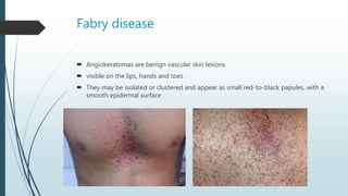 Neurocutaneous markers ..by dr shiv kumar saini | PPTX