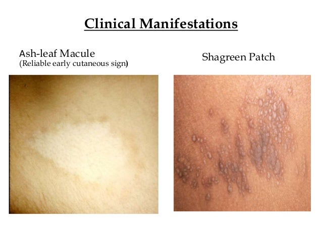Neurocutaneous