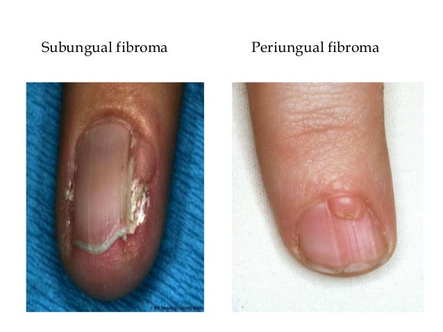 Neurocutaneous