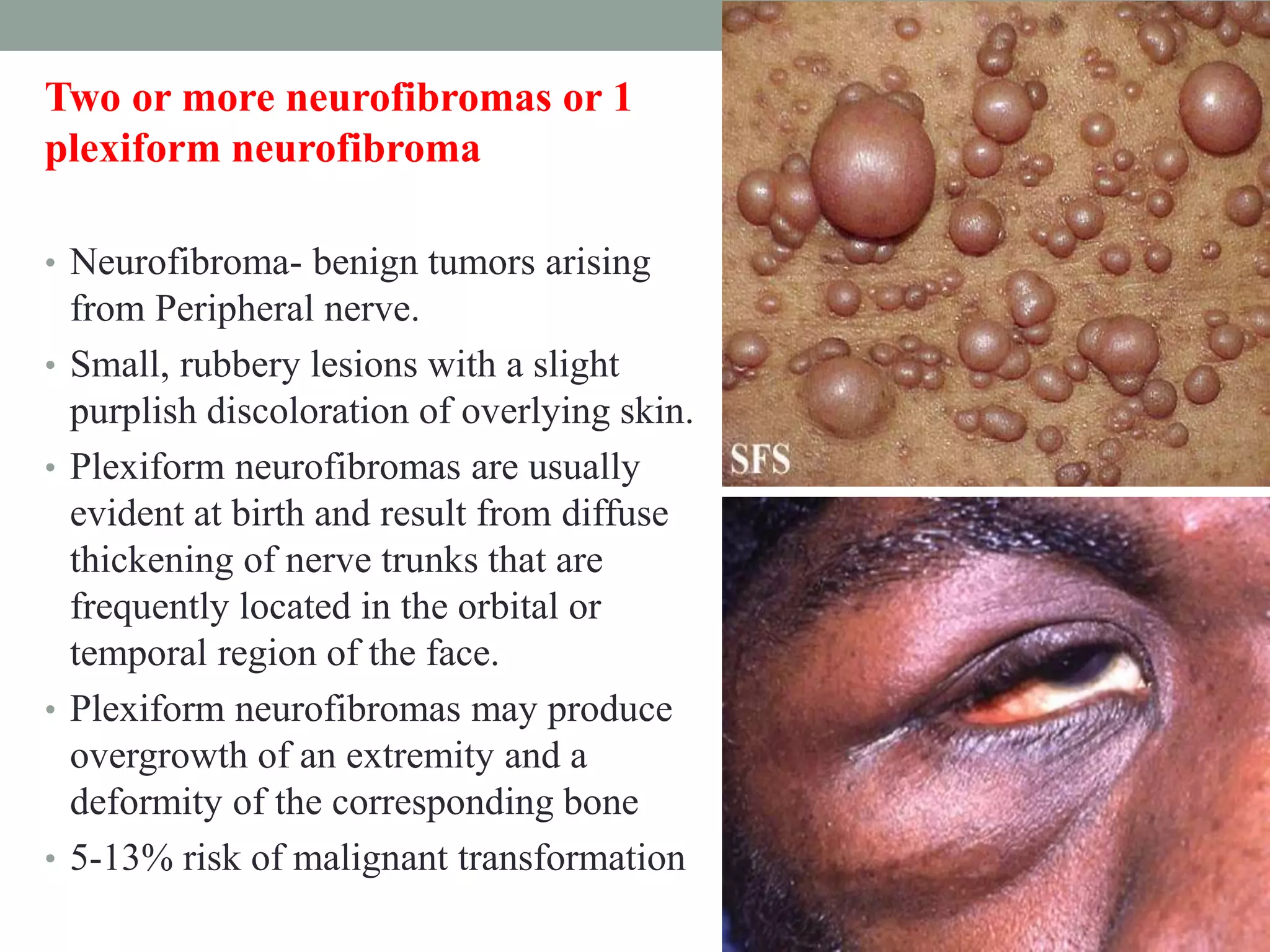 Neurocutaneous syndrome | PPTX