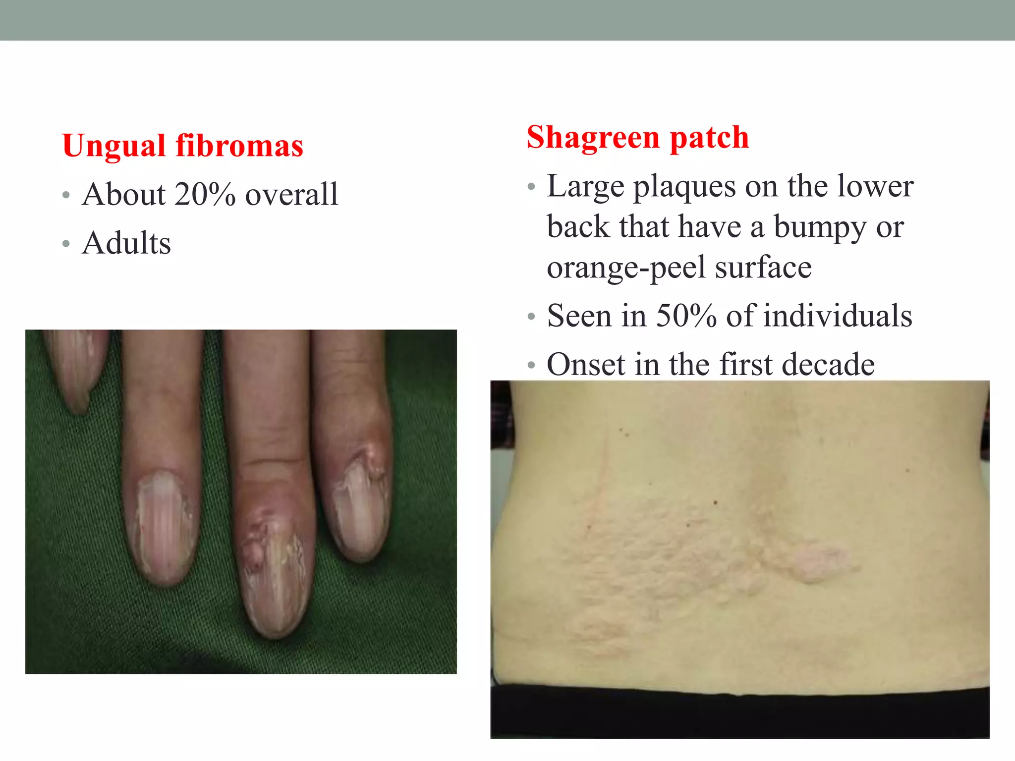 Neurocutaneous syndrome | PPTX