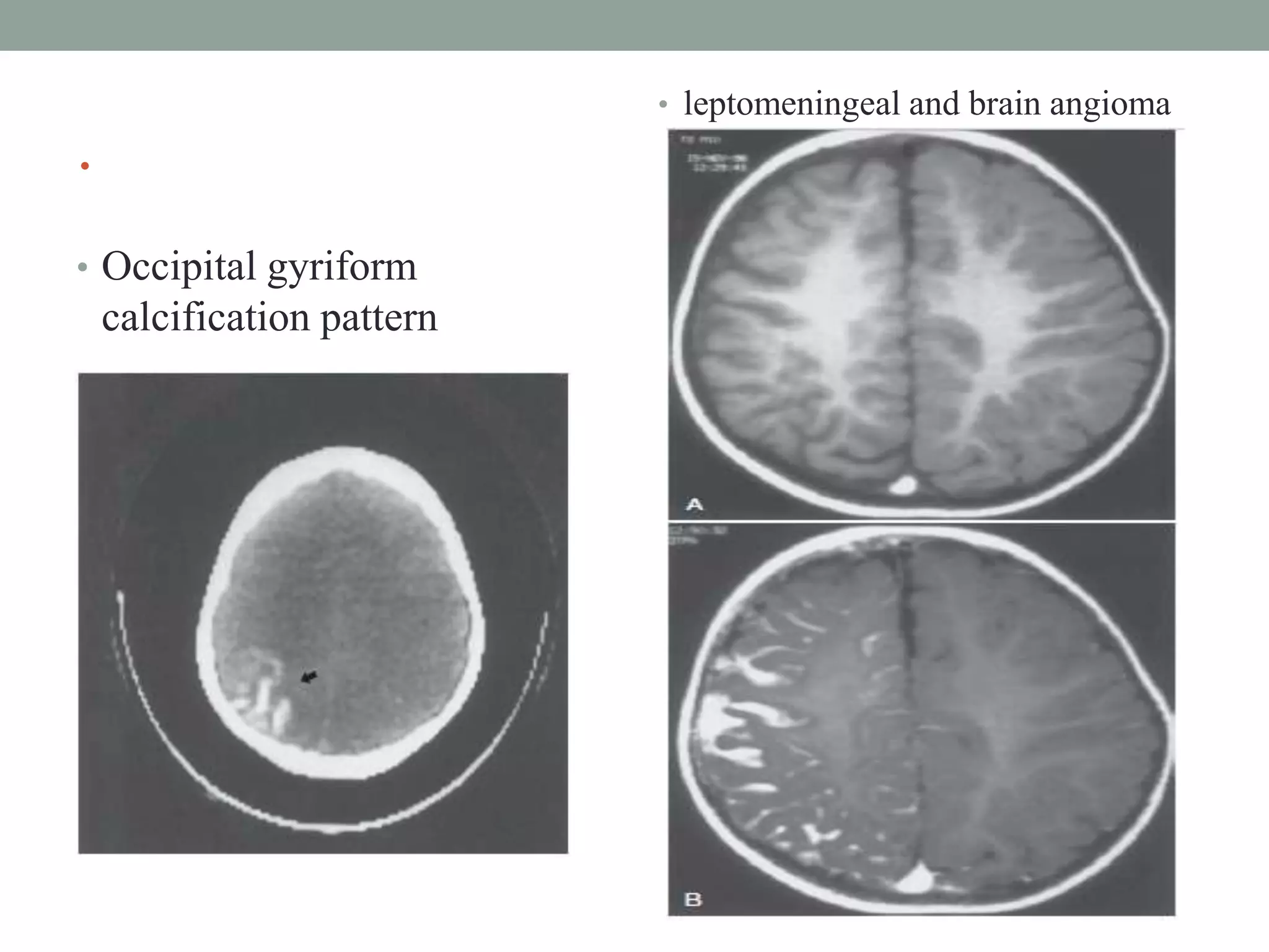 Neurocutaneous syndrome | PPTX