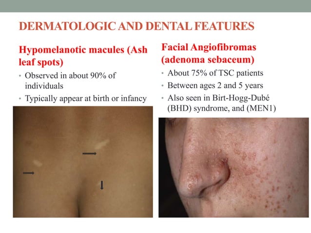 Neurocutaneous syndrome | PPTX | Skin and Dermatology | Diseases and ...