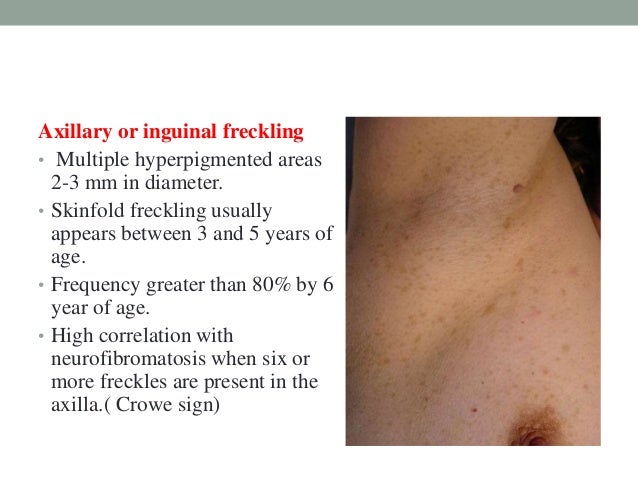 Neurocutaneous syndrome
