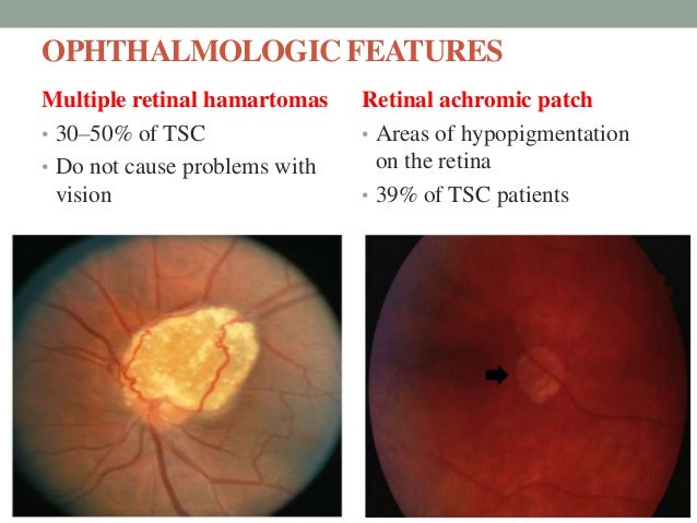 Neurocutaneous syndrome
