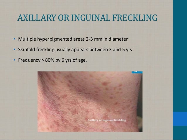 Neurocutaneous syndrome