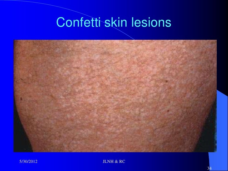 Confetti Skin Lesions Images at Courtney Menard blog